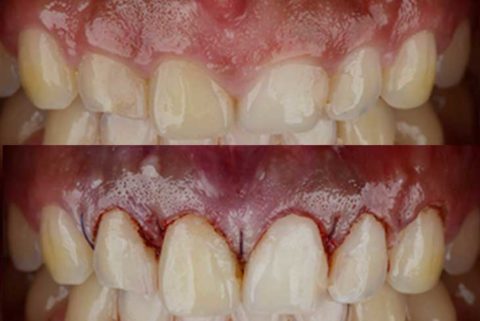 Gum Contouring In Dubai (2025) | GYA Dental Center