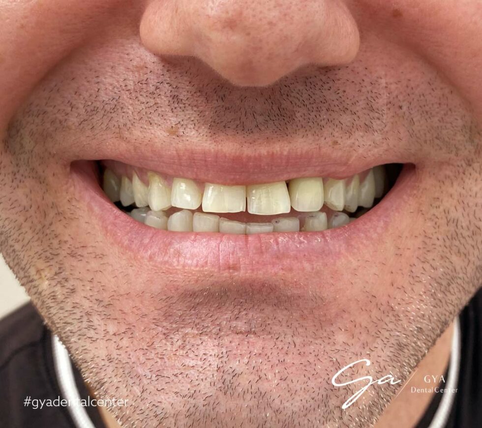 Looking for Best Dental Veneers in Dubai in 2025? | GYA Dental Center