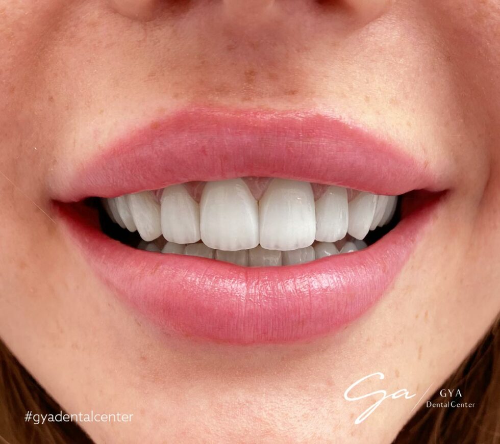 Looking for Best Dental Veneers in Dubai in 2025? | GYA Dental Center